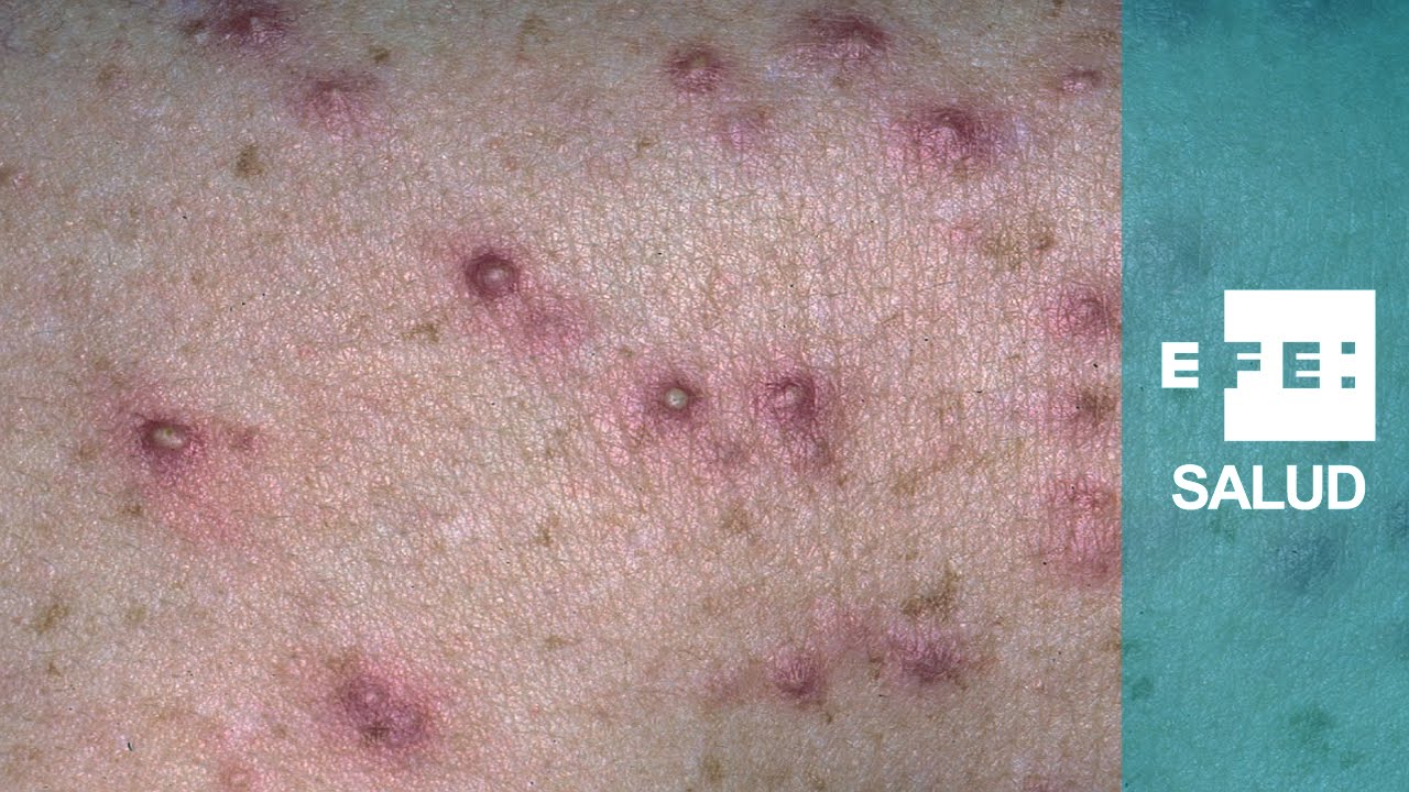 Descubre qué usar para el acné comedogénico