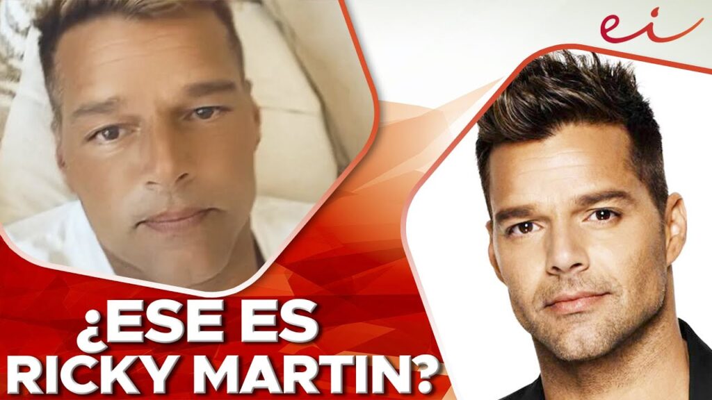 Qué tratamiento se hizo Ricky Martin en la cara