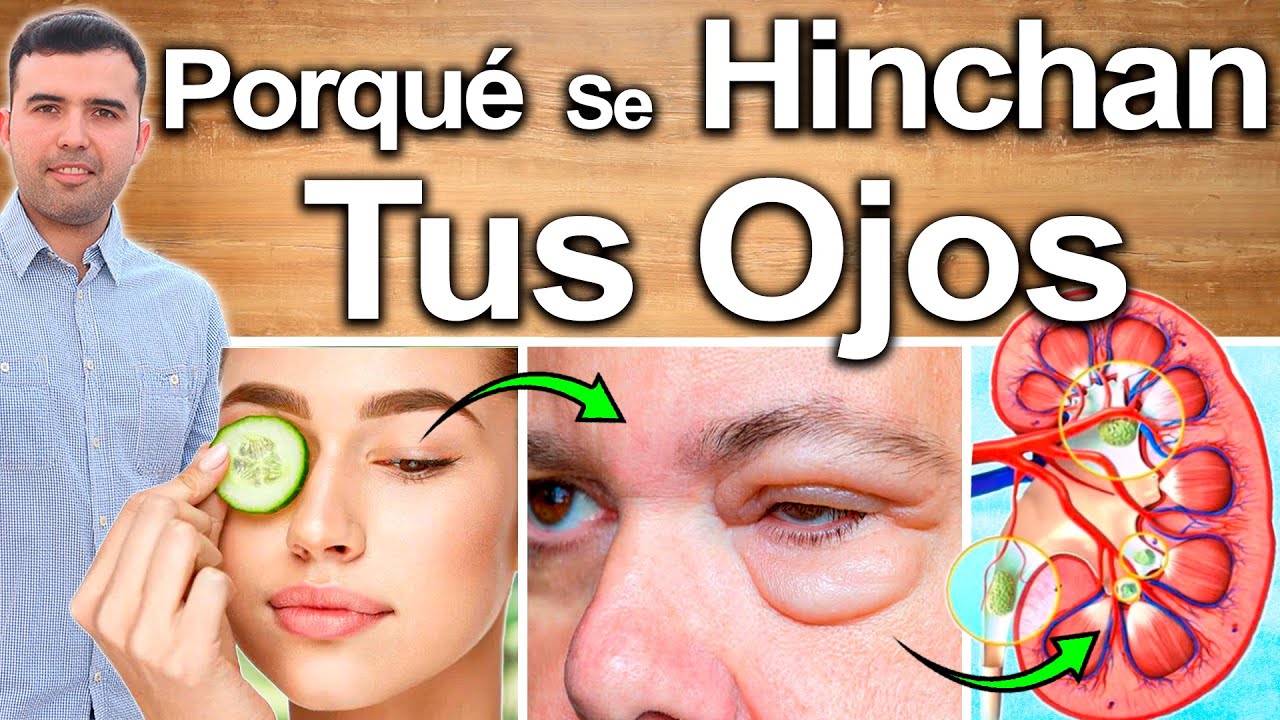 5 causas comunes de hinchazón en los ojos y cómo tratarlas
